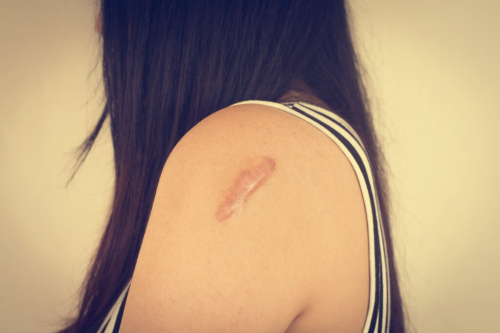 How to Minimize Wound Scars | Schulke Asia